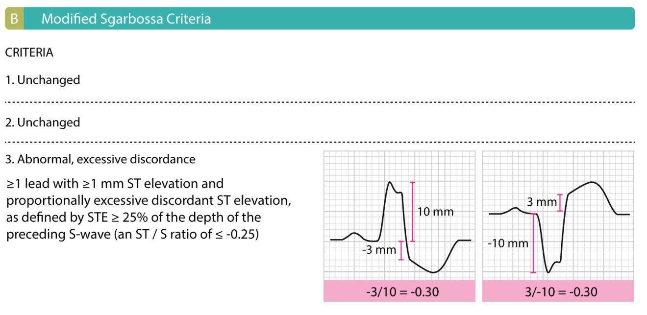 Left bundle branch block (LBBB) in acute myocardial infarction: the ...