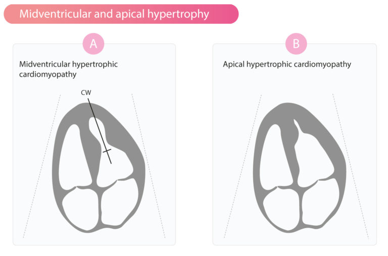 Hypertrophic Cardiomyopathy (HCM) & Hypertrophic Obstructive ...