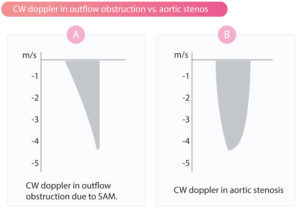 Hypertrophic Cardiomyopathy (HCM) & Hypertrophic Obstructive ...