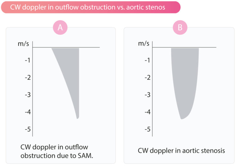 Hypertrophic Cardiomyopathy (HCM) & Hypertrophic Obstructive ...