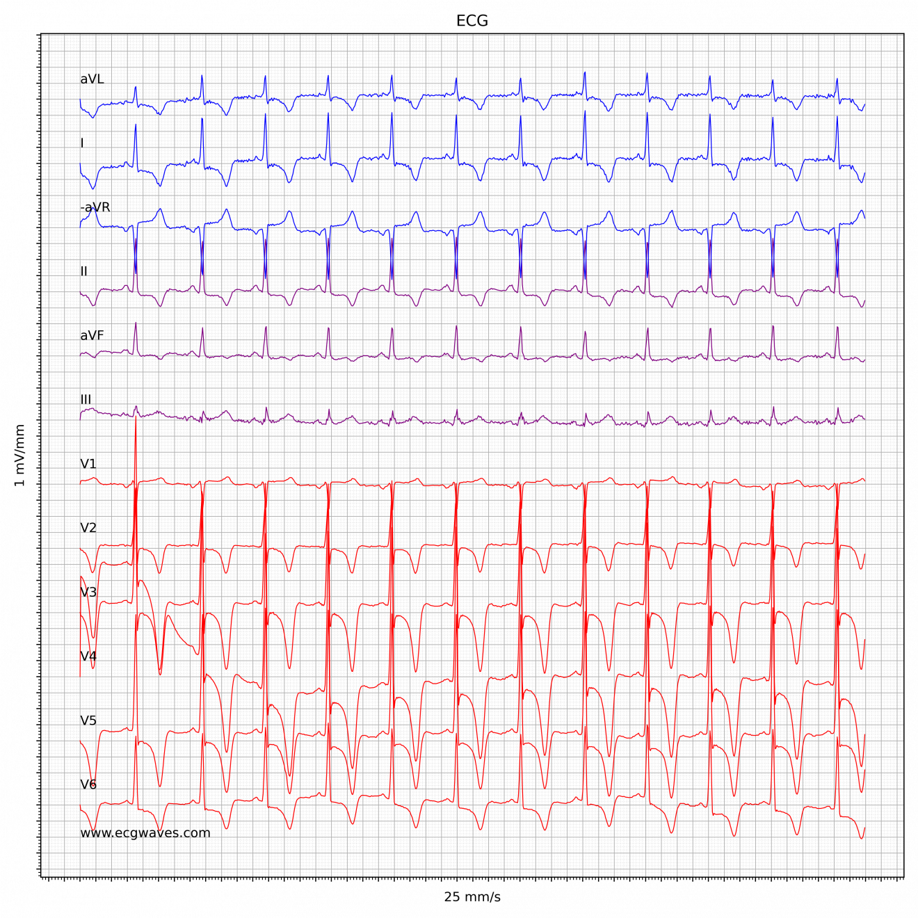 Hypertrophic Cardiomyopathy (HCM) & Hypertrophic Obstructive ...