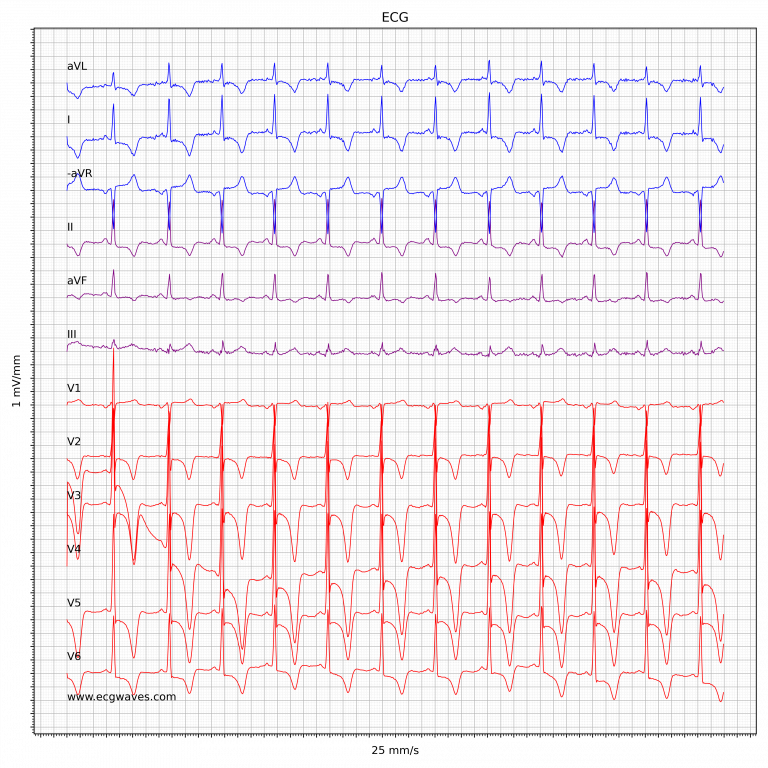 Hypertrophic Cardiomyopathy (HCM) & Hypertrophic Obstructive ...