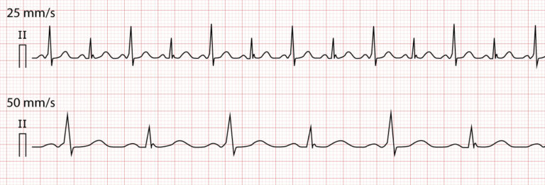 Pre-excitation, Atrioventricular Reentrant (Reentry) Tachycardia (AVRT ...