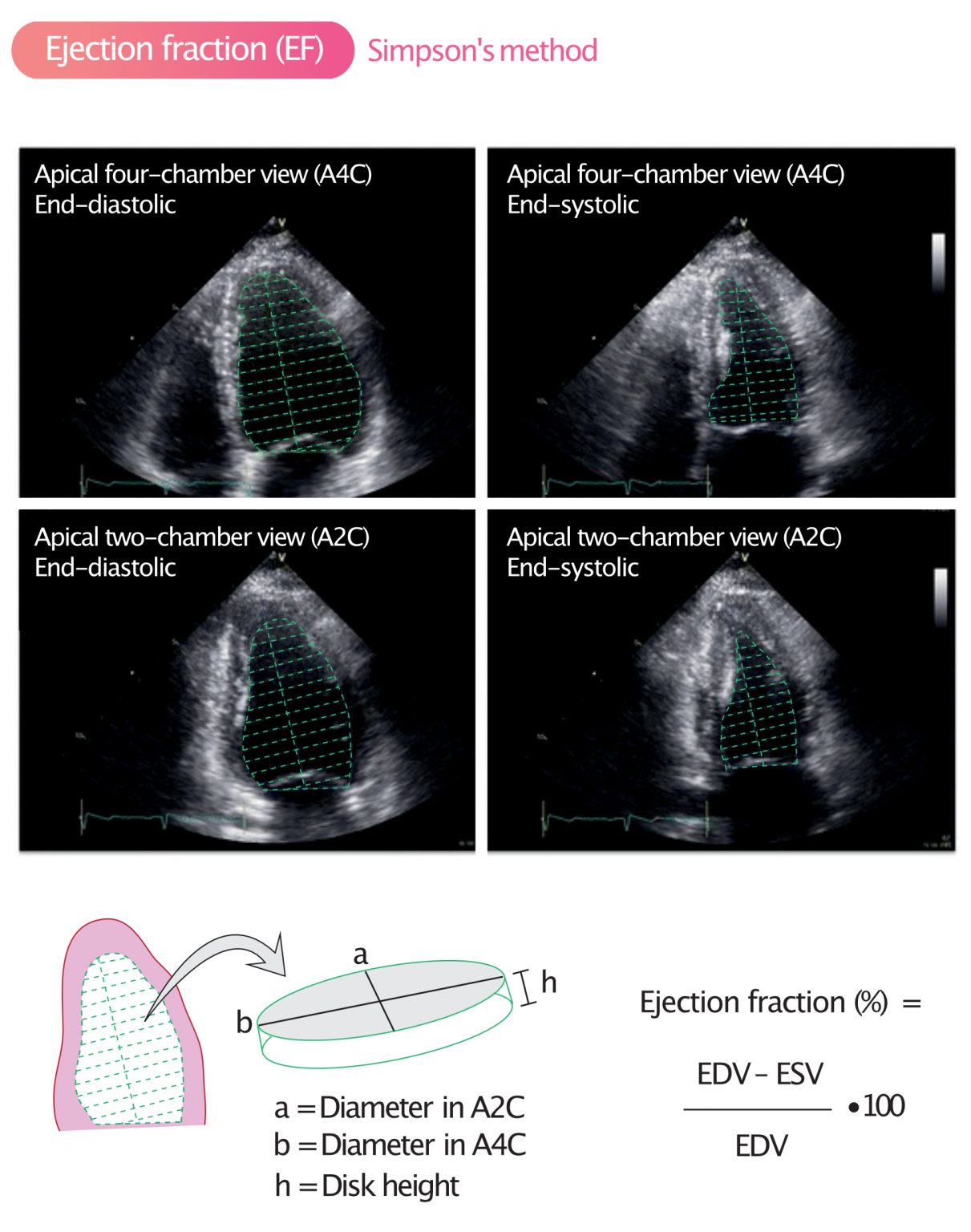 Ejection fraction (EF): Physiology, Measurement & Clinical Evaluation ...