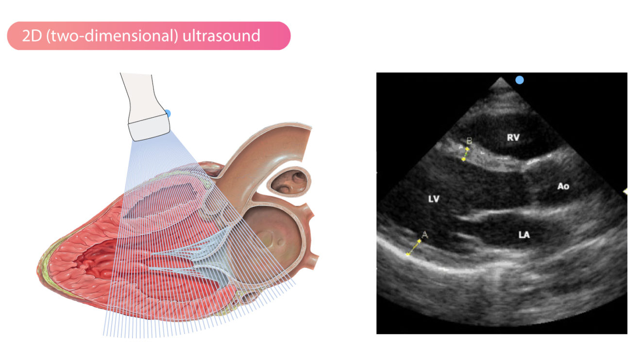 Two-dimensional (2D) echocardiography – The Cardiovascular