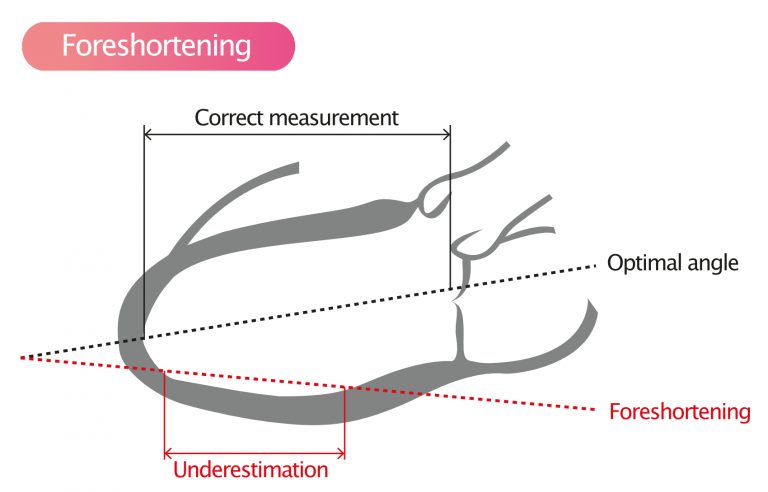 Ejection fraction (EF): Physiology, Measurement & Clinical Evaluation ...