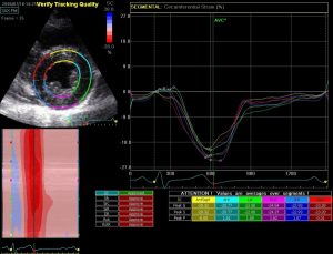 Strain, strain rate and speckle tracking: Myocardial deformation – The ...