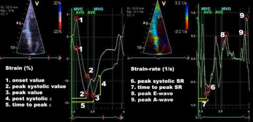 Strain, strain rate and speckle tracking: Myocardial deformation – The ...