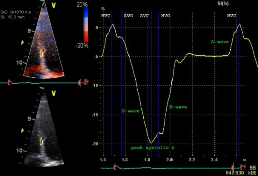 Strain, strain rate and speckle tracking: Myocardial deformation – The ...