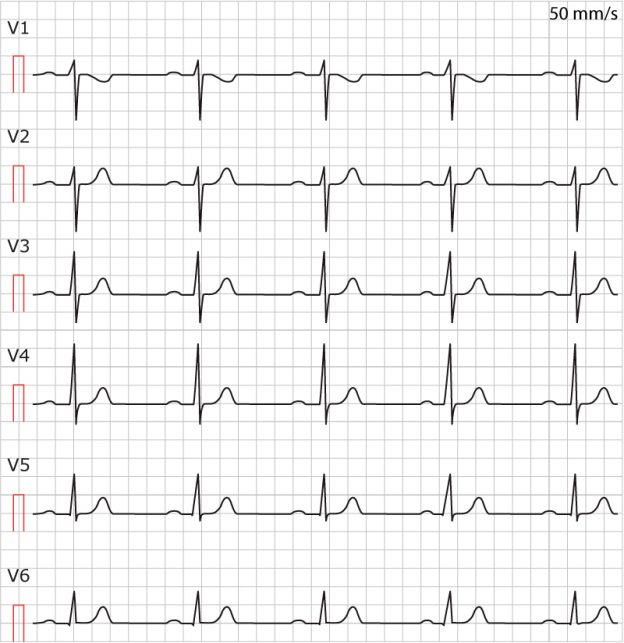 Interpretation of neonatal and pediatric electrocardiograms (ECG) – ECG ...