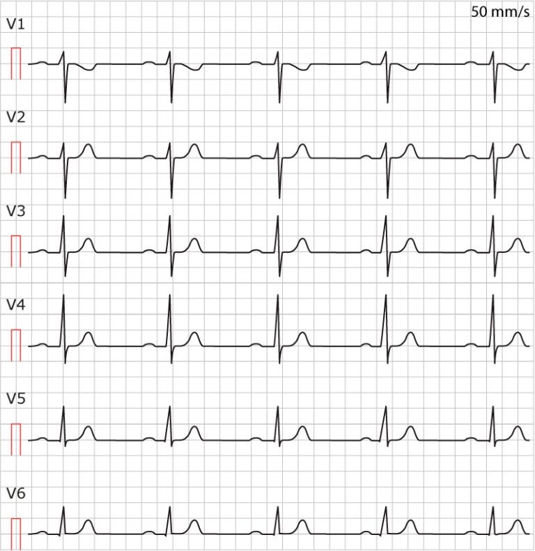 Interpretation of neonatal and pediatric electrocardiograms (ECG) – The ...