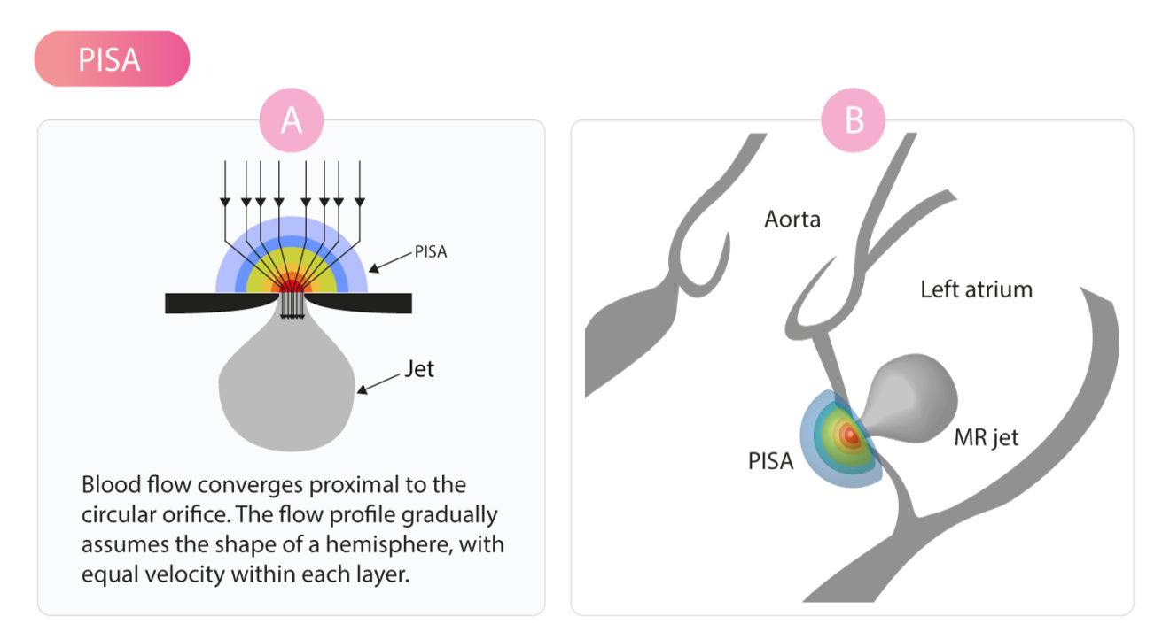 Proximal Isovelocity Surface Area (PISA) – The Cardiovascular