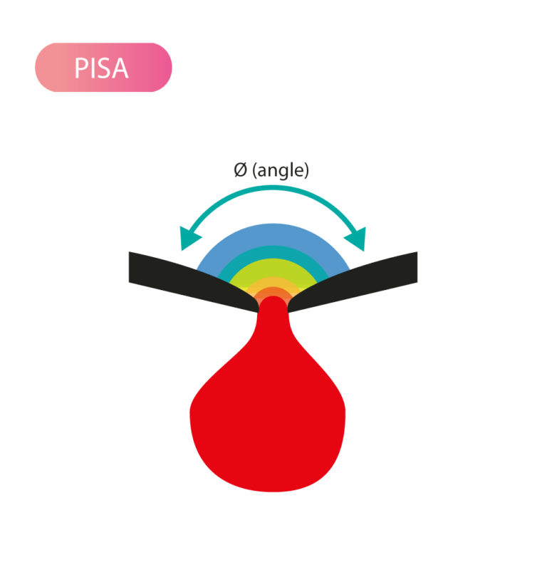Proximal Isovelocity Surface Area (PISA) – The Cardiovascular
