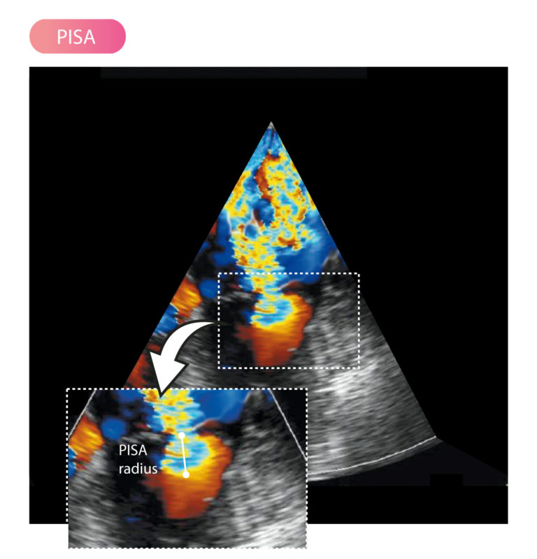 Proximal Isovelocity Surface Area (PISA) – The Cardiovascular