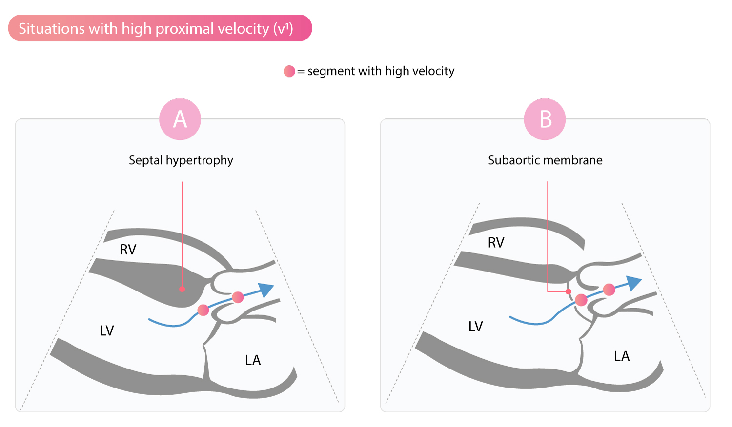 The Bernoulli principle and estimation of pressure gradients – The ...