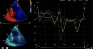 Tissue Doppler (Tissue Velocity Imaging) – The Cardiovascular