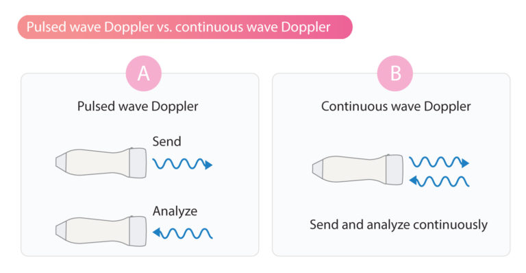 Continuous Wave Doppler (CW Doppler) – The Cardiovascular Continuous Wave Doppler (CW Doppler) – The Cardiovascular