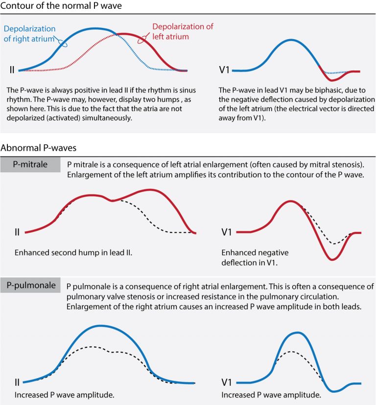 Interpretation of neonatal and pediatric electrocardiograms (ECG) – The ...