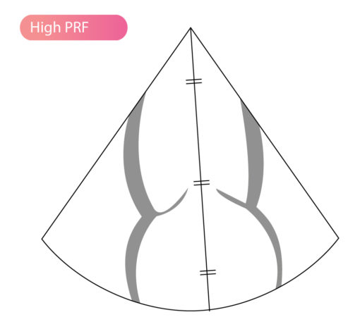 Pulsed Wave Doppler – The Cardiovascular