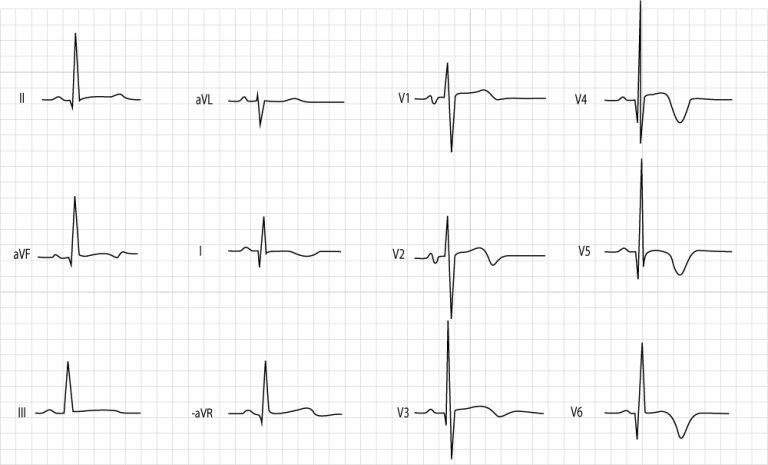 Interpretation of neonatal and pediatric electrocardiograms (ECG) – ECG ...
