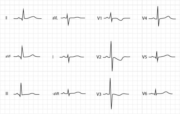 Interpretation of neonatal and pediatric electrocardiograms (ECG) – ECG ...