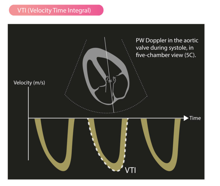 Stroke Volume, VTI (Velocity Time Integral) & Cardiac Output – The ...