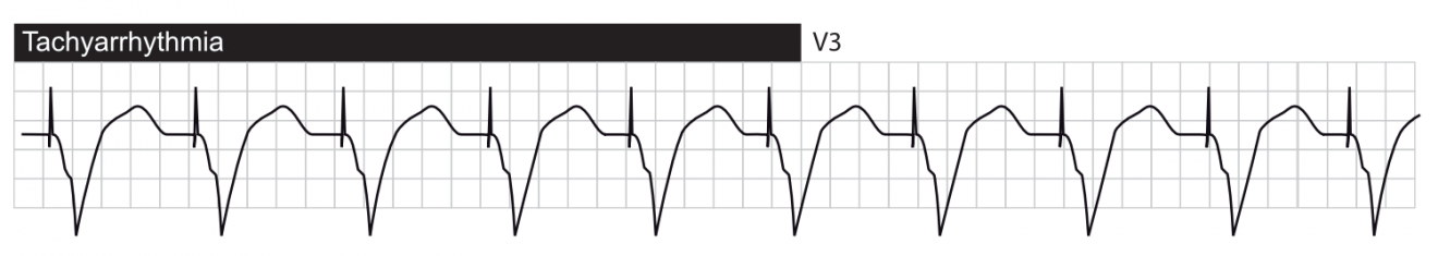 Assessment of Pacemaker Malfunction – The Cardiovascular