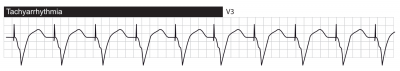 Assessment of Pacemaker Malfunction – The Cardiovascular