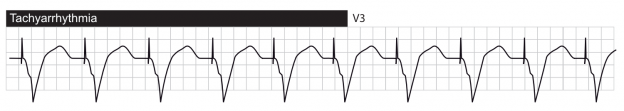 Assessment of Pacemaker Malfunction – The Cardiovascular