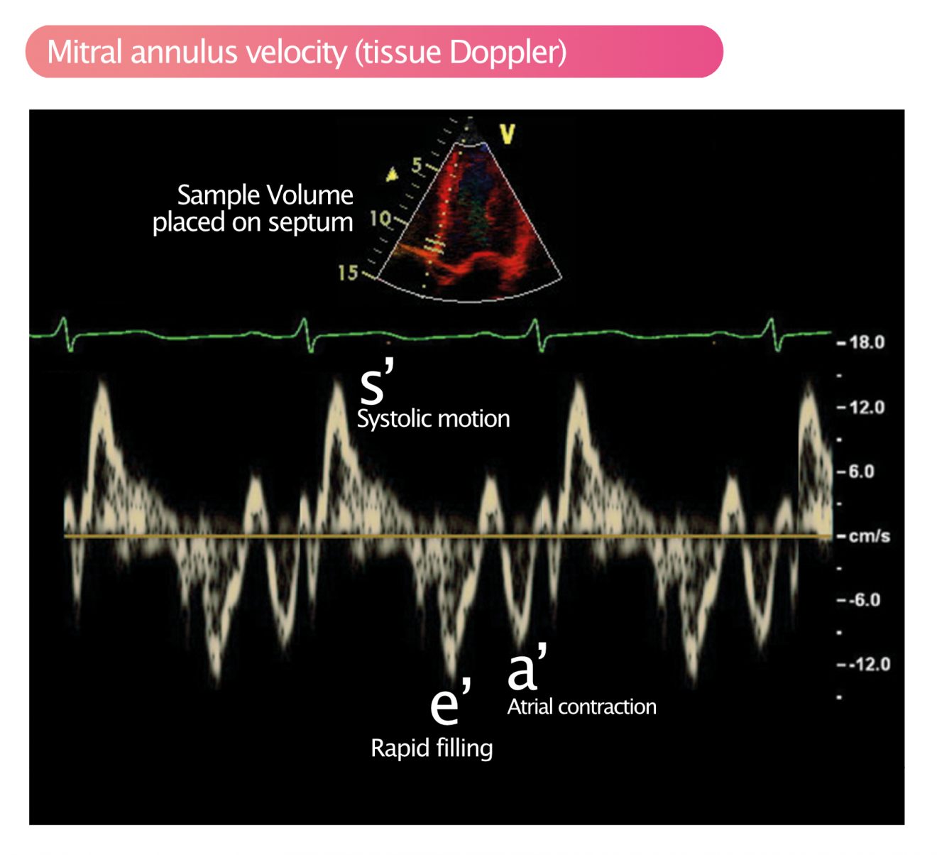 Strain, strain rate and speckle tracking: Myocardial deformation – The ...