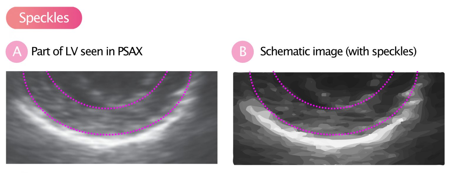 Strain, strain rate and speckle tracking: Myocardial deformation – The ... Strain, strain rate and speckle tracking: Myocardial deformation – The ...