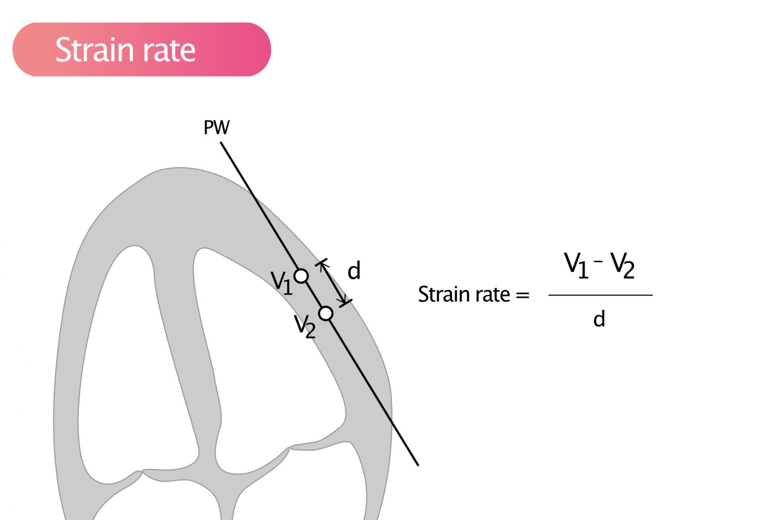 Strain, strain rate and speckle tracking: Myocardial deformation – The ...