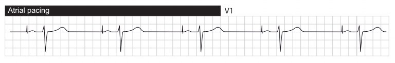 Interpretation of Pacemaker ECG – The Cardiovascular