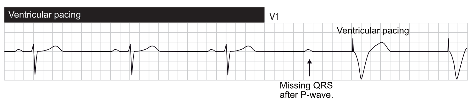 Interpretation of Pacemaker ECG – The Cardiovascular