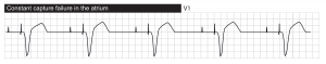 Assessment of Pacemaker Malfunction – The Cardiovascular