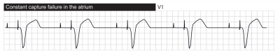 Assessment of Pacemaker Malfunction – The Cardiovascular
