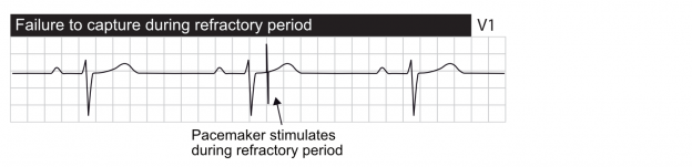 Assessment of Pacemaker Malfunction – The Cardiovascular