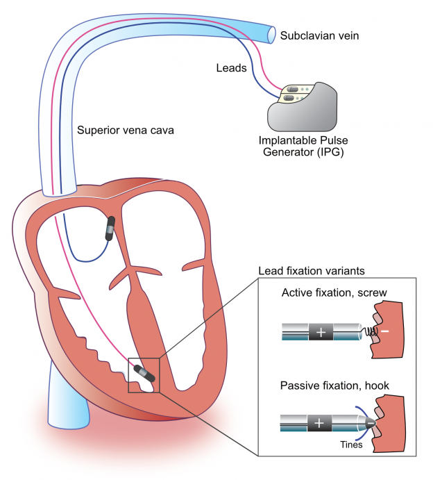 Components and construction of a pacemaker – The Cardiovascular