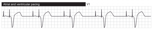 Interpretation of Pacemaker ECG – The Cardiovascular