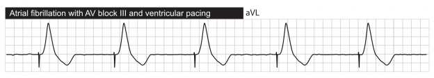 Interpretation of Pacemaker ECG – The Cardiovascular