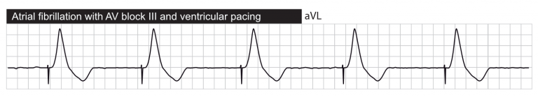 Interpretation of Pacemaker ECG – The Cardiovascular