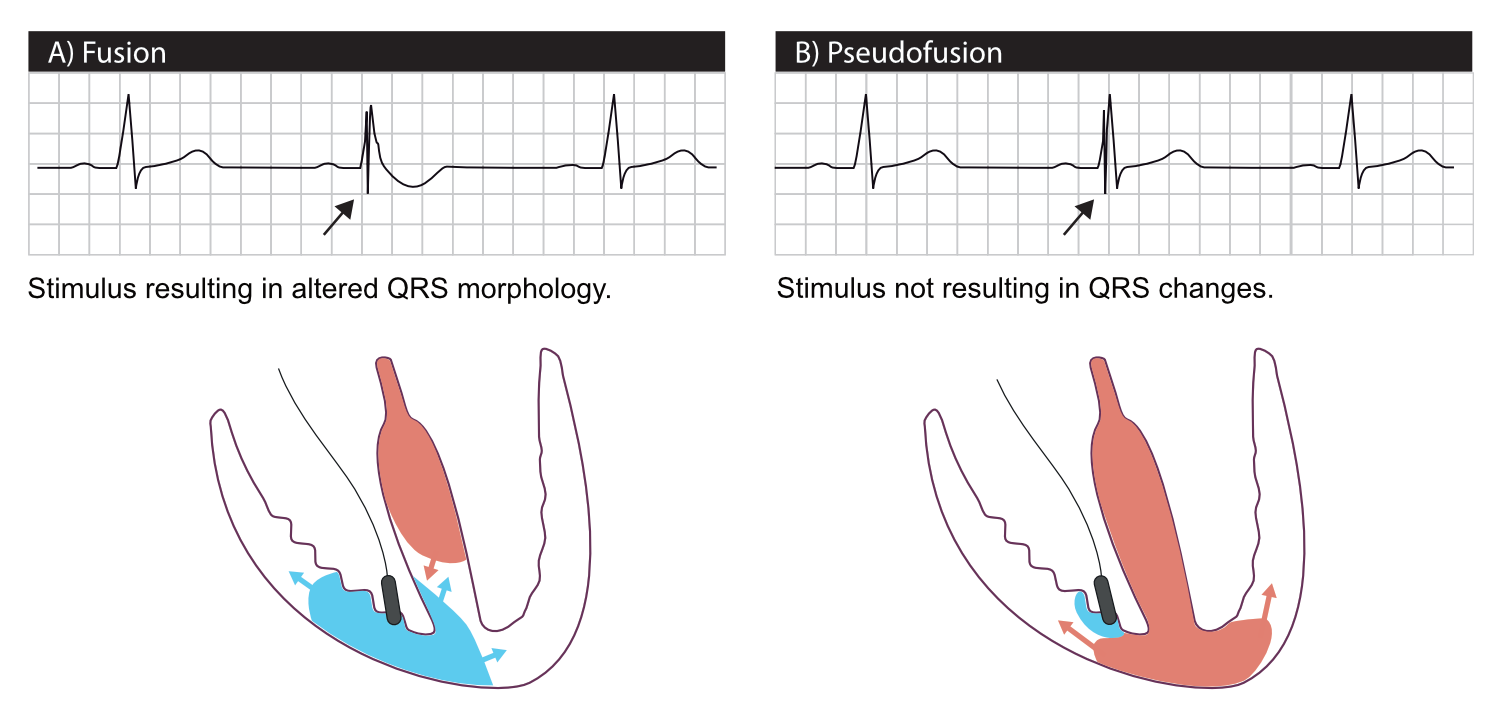Interpretation of Pacemaker ECG – The Cardiovascular