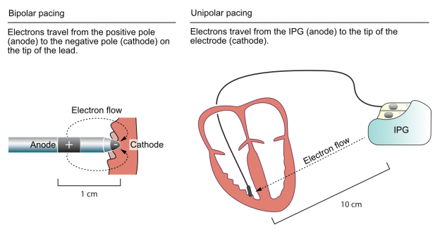Components and construction of a pacemaker – The Cardiovascular