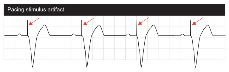 Interpretation of Pacemaker ECG – The Cardiovascular