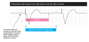 Basic cardiac pacing, pacemaker functions and settings – ECG & ECHO