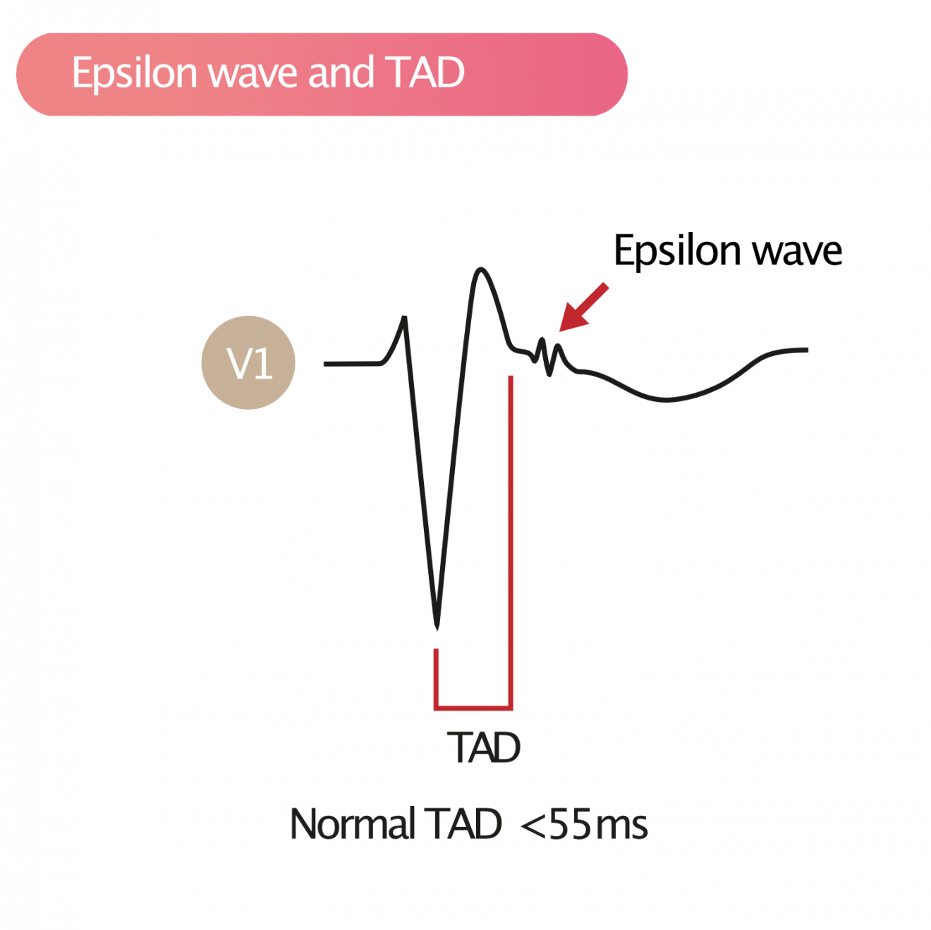 Arrhythmogenic Right Ventricular Cardiomyopathy / Dysplasia (ARVC, ARVD ...