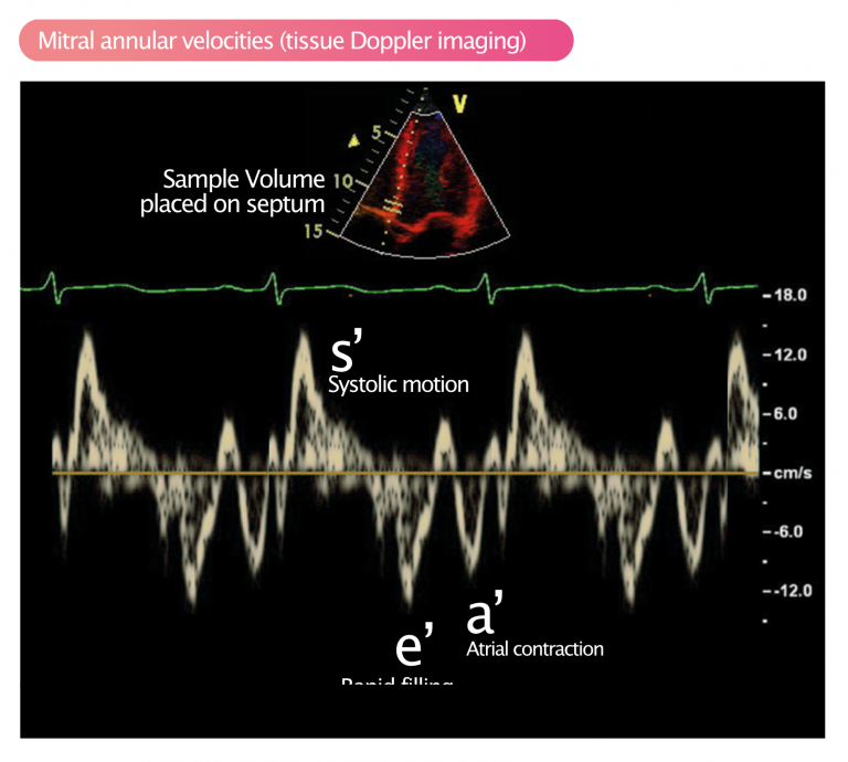 Assessment of diastolic function by echocardiography – The Cardiovascular