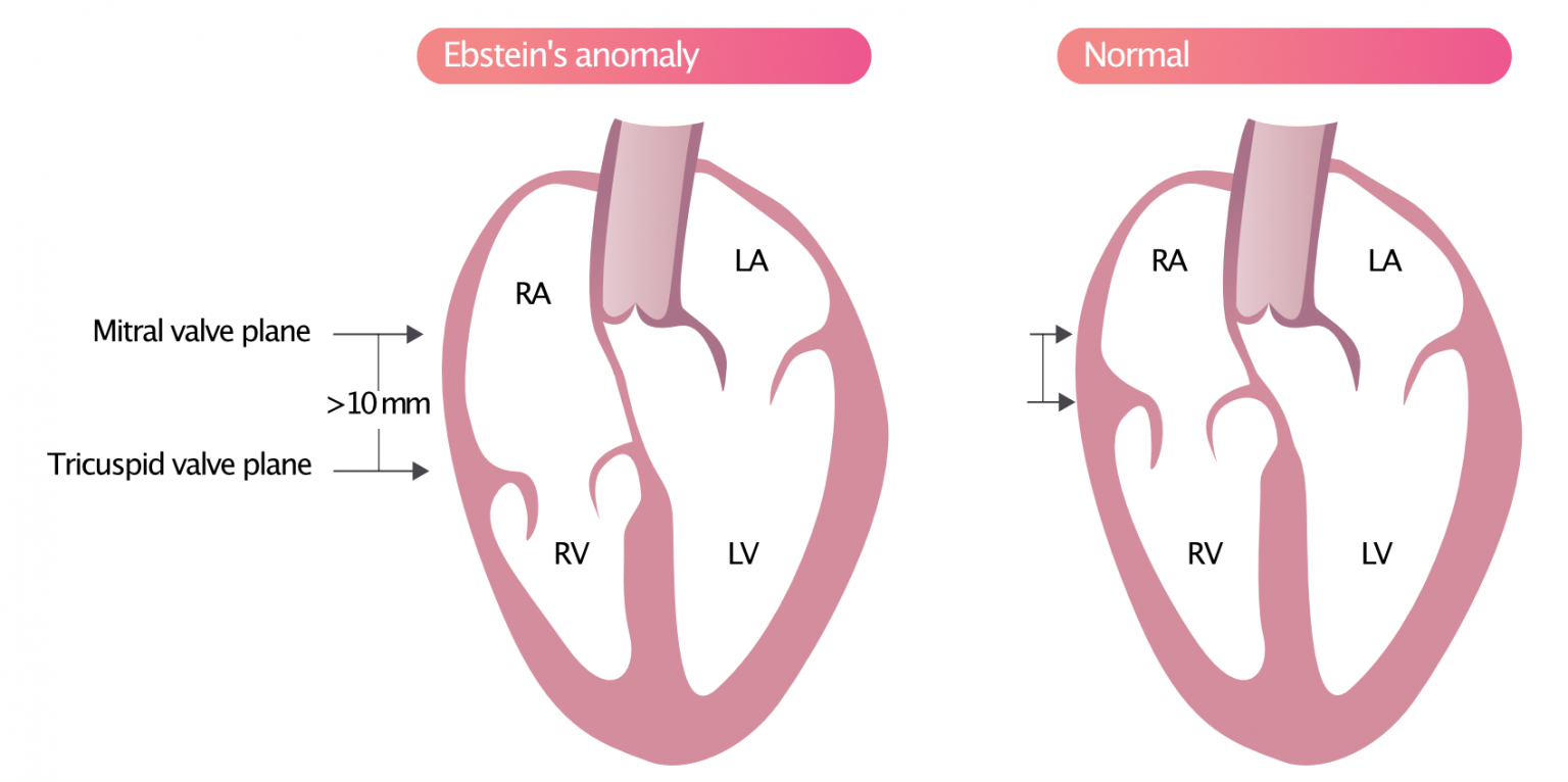 Tricuspid regurgitation (TR/TI) - Echocardiography, diagnosis, causes ...