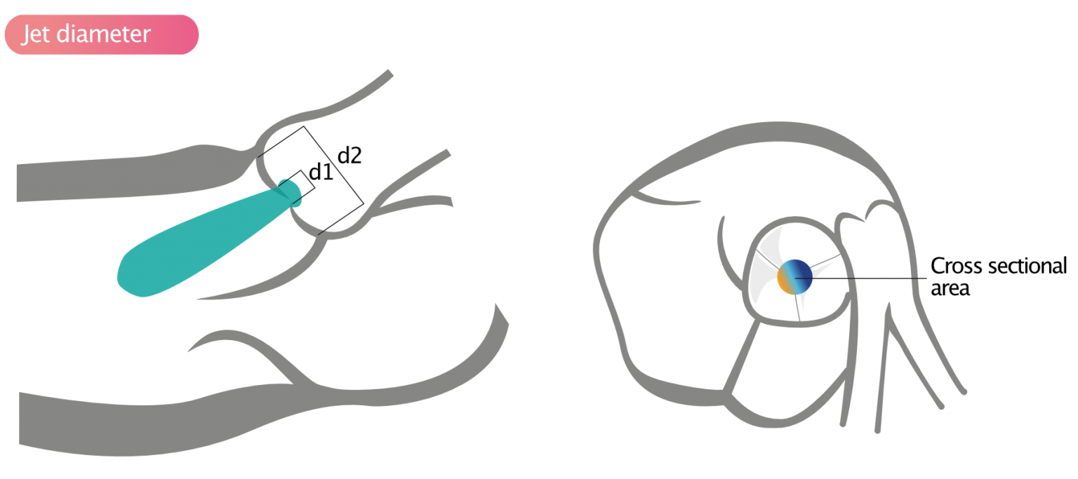 Aortic regurgitation - Echocardiography, diagnosis, grading, severity