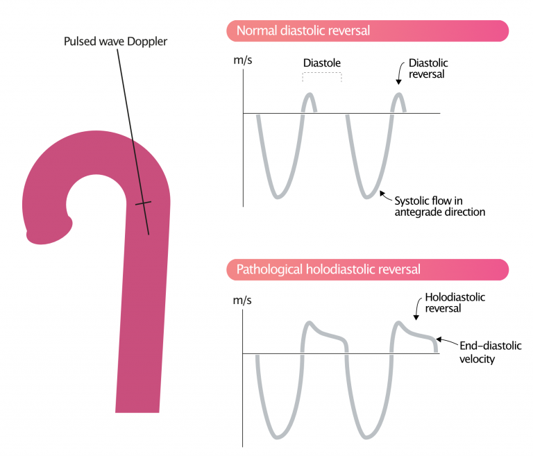 Aortic regurgitation - Echocardiography, diagnosis, grading, severity